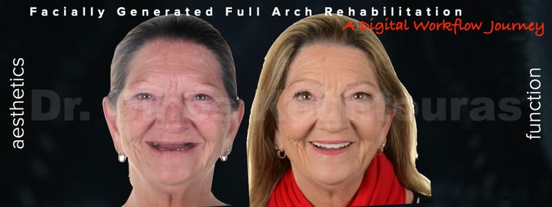 Digital Workflow Journey With Facially Generated Full Mouth Rehabilitation